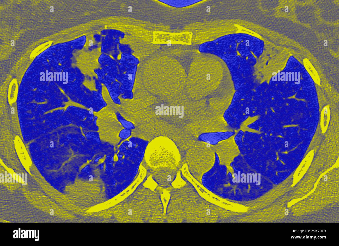 Organizing pneumonia. Coloured axial computed tomography (CT) scan ...