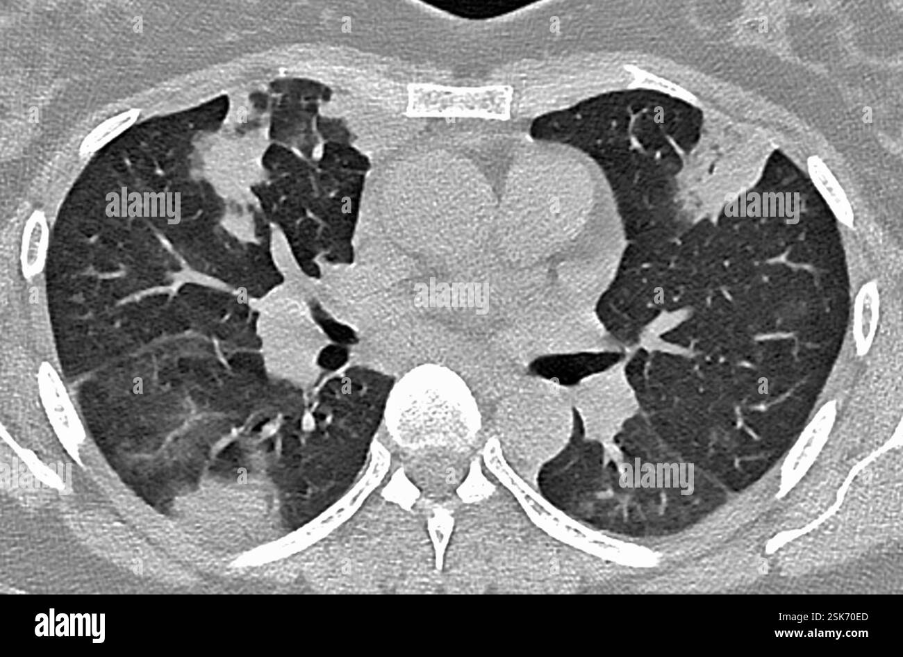Organizing pneumonia. Axial computed tomography (CT) scan through the ...