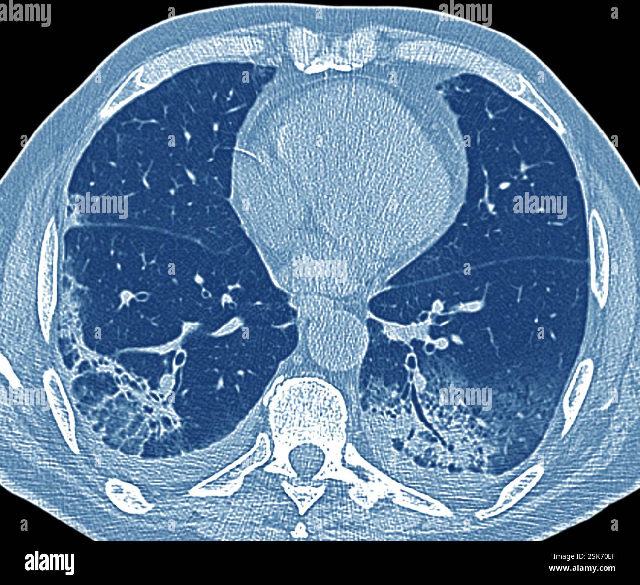 Organizing pneumonia. Axial computed tomography (CT) scan through the ...