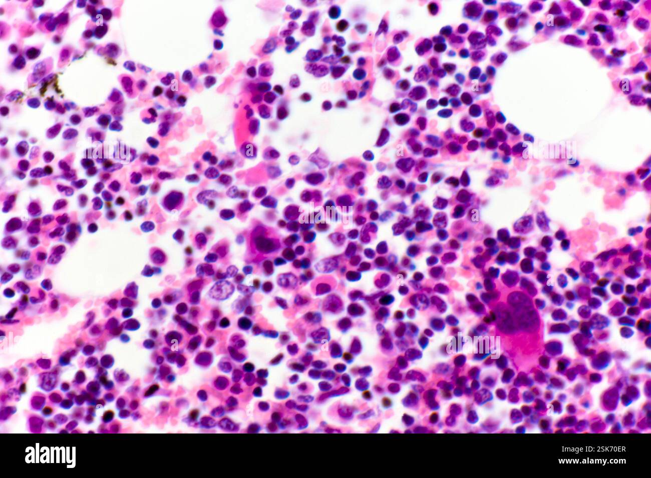 Bone marrow. Light micrograph of a section through a sample of bone ...