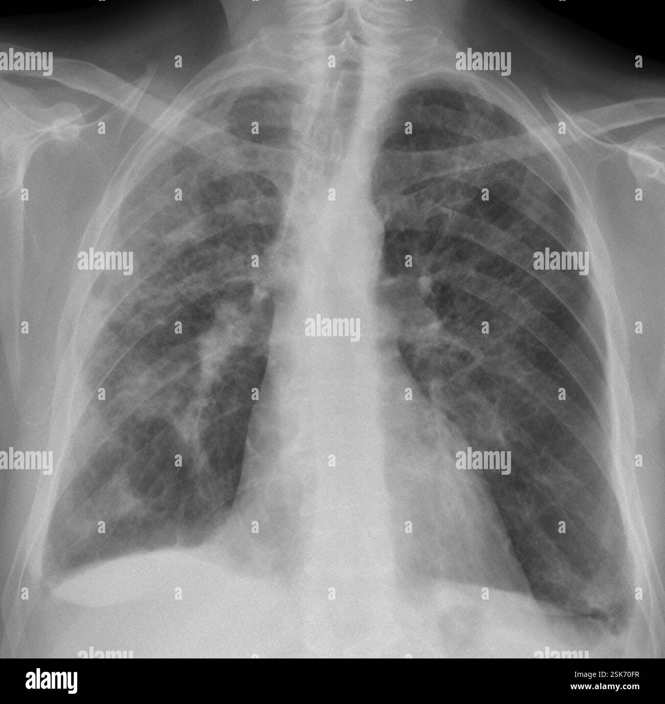 Organizing pneumonia. Frontal chest X-ray of the lungs of a 71-year-old ...