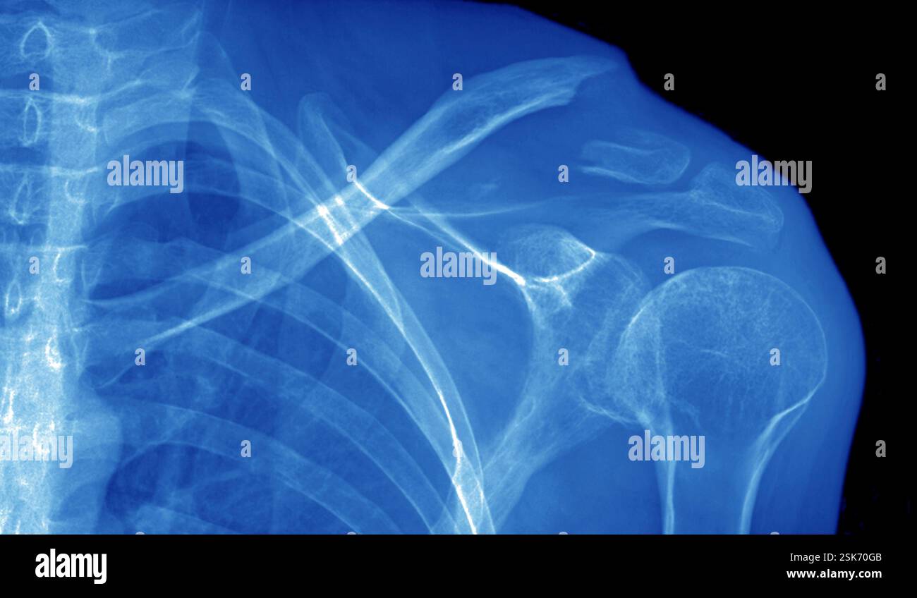 Collar bone fracture. Frontal X-ray of the left shoulder of a 40-year ...
