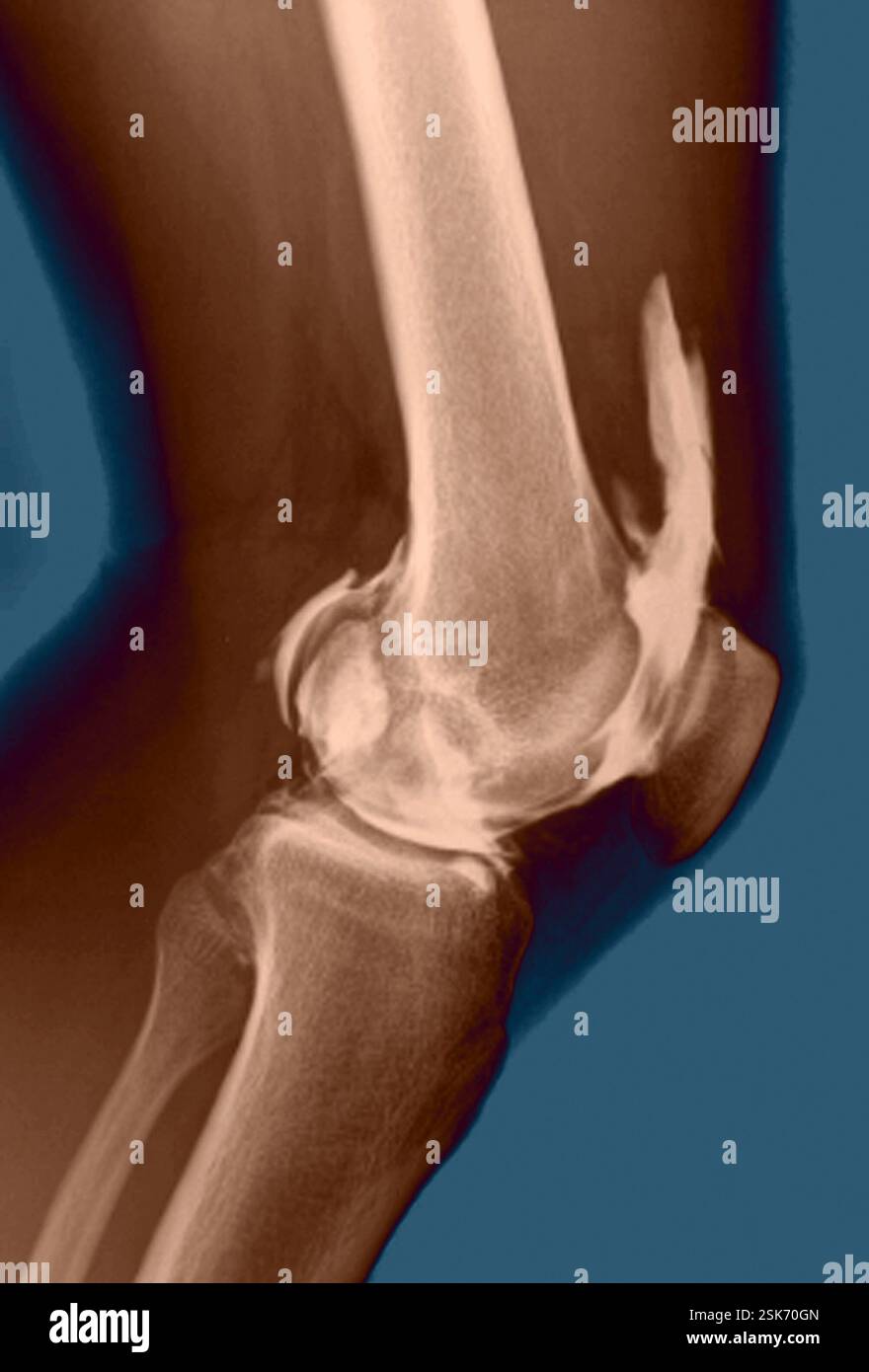 Swollen knee. Coloured X-ray of a 28-year-old man's left kne with ...