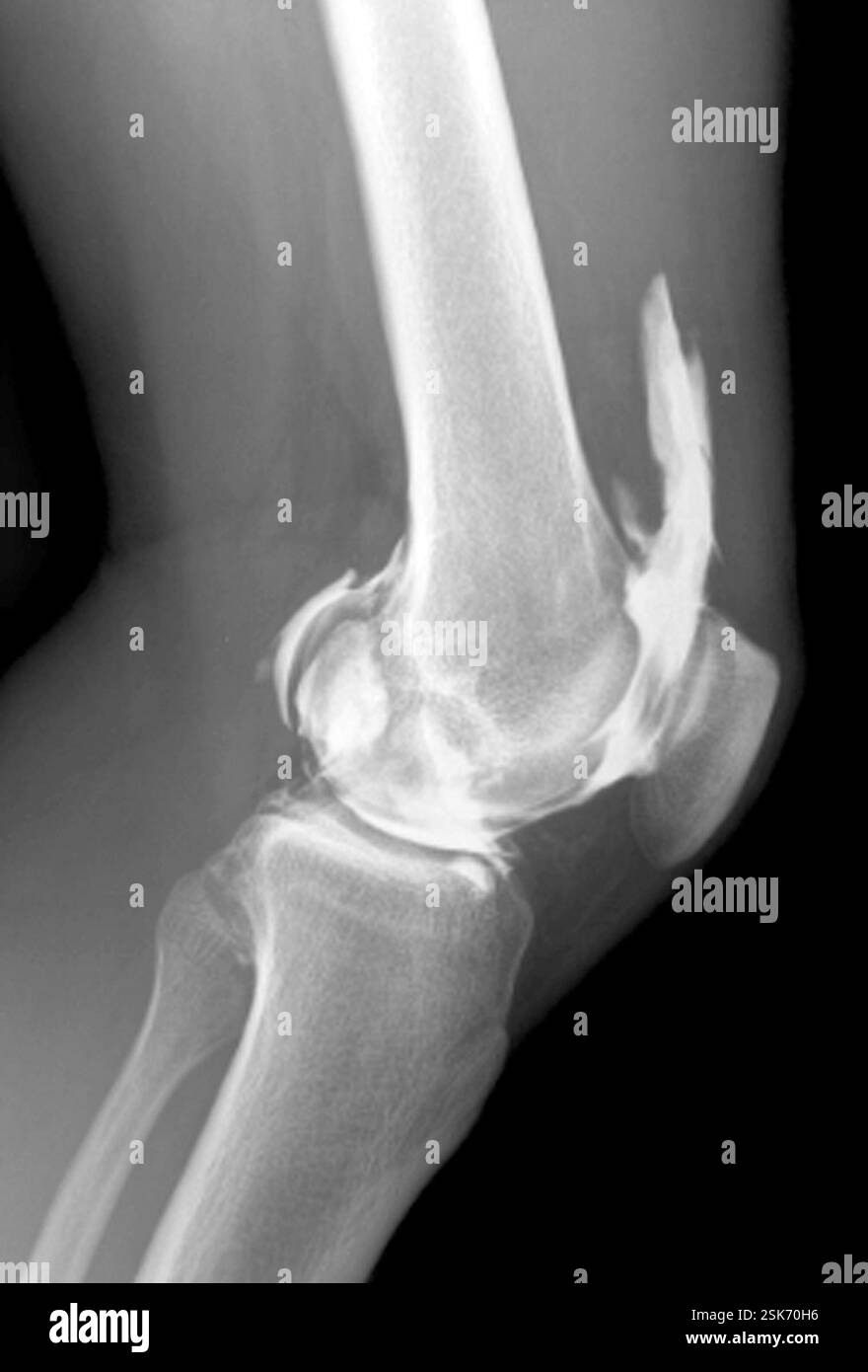 Swollen knee. X-ray of a 28-year-old man's left kne with bursitis, a ...