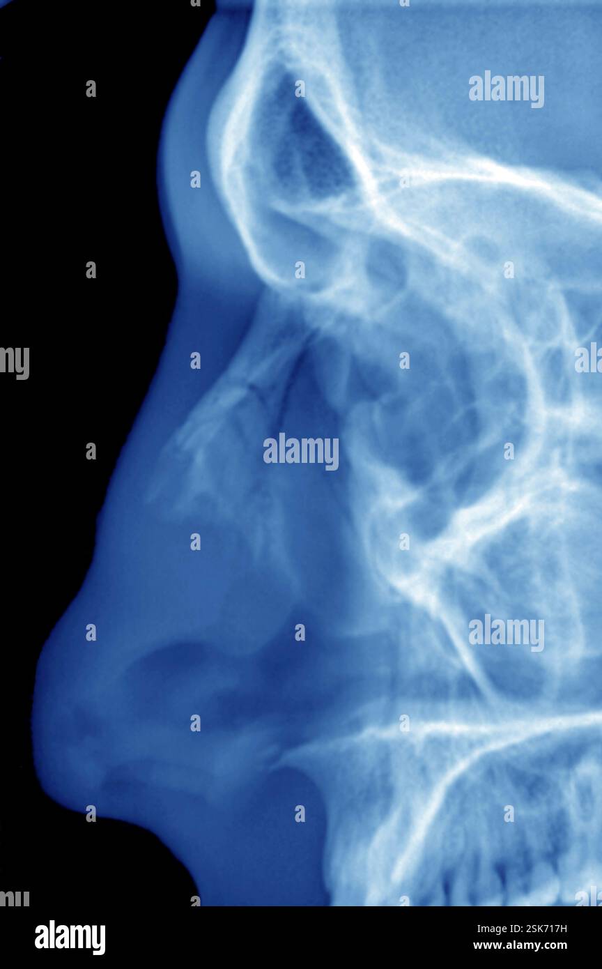 Nose bone fractures. Lateral X-ray of the nose of a 20-year-old man ...