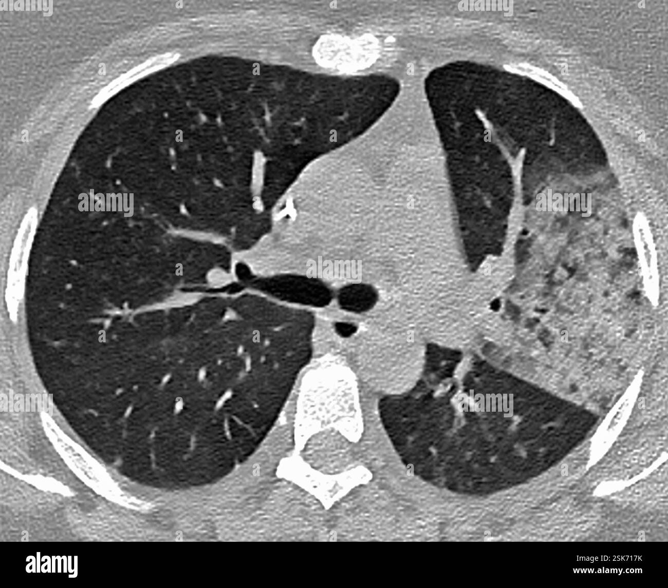 Bacterial pneumonia. Axial computed tomography (CT) scan through the ...