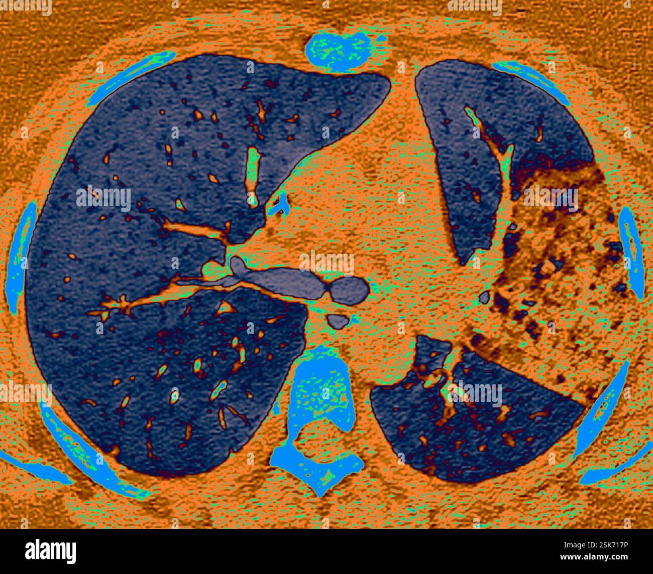 Bacterial pneumonia. Coloured Axial computed tomography (CT) scan ...