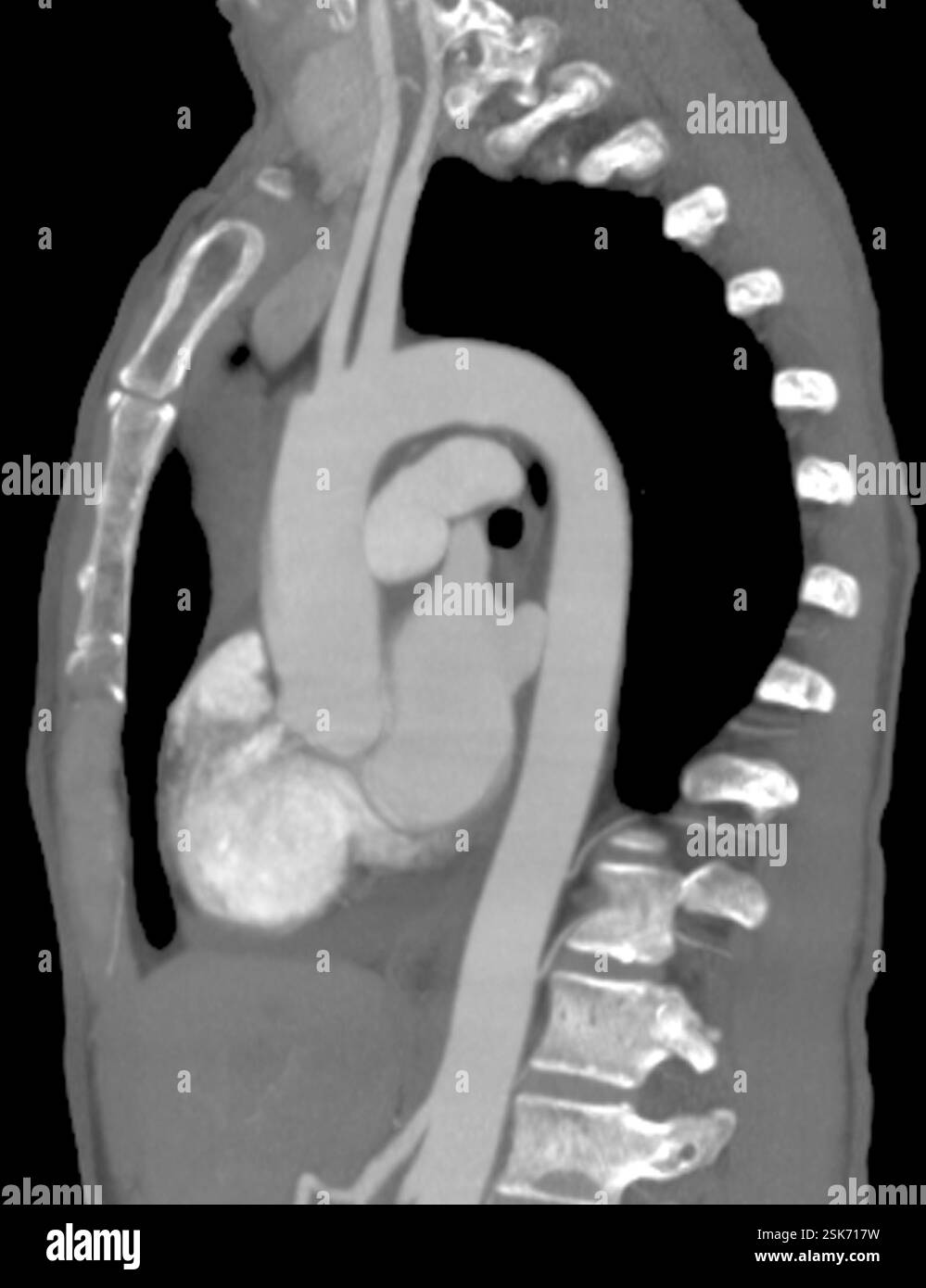 Heart and aorta. Sagittal computed tomography (CT) angiography scan ...