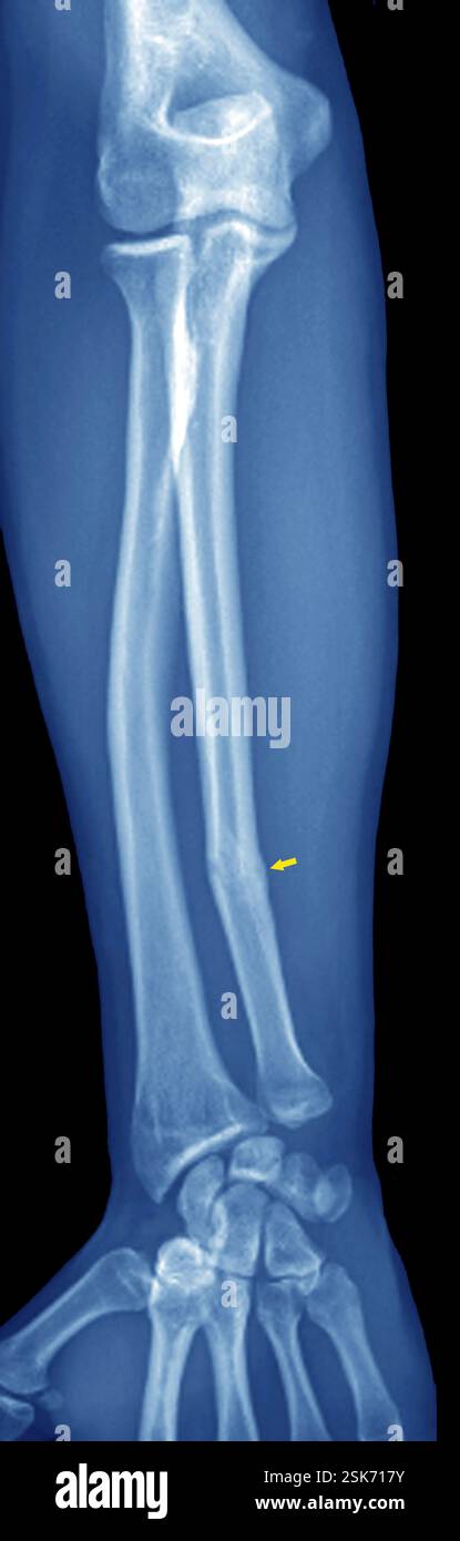 Callus after radius bone fracture. Frontal X-ray of the left forearm of ...