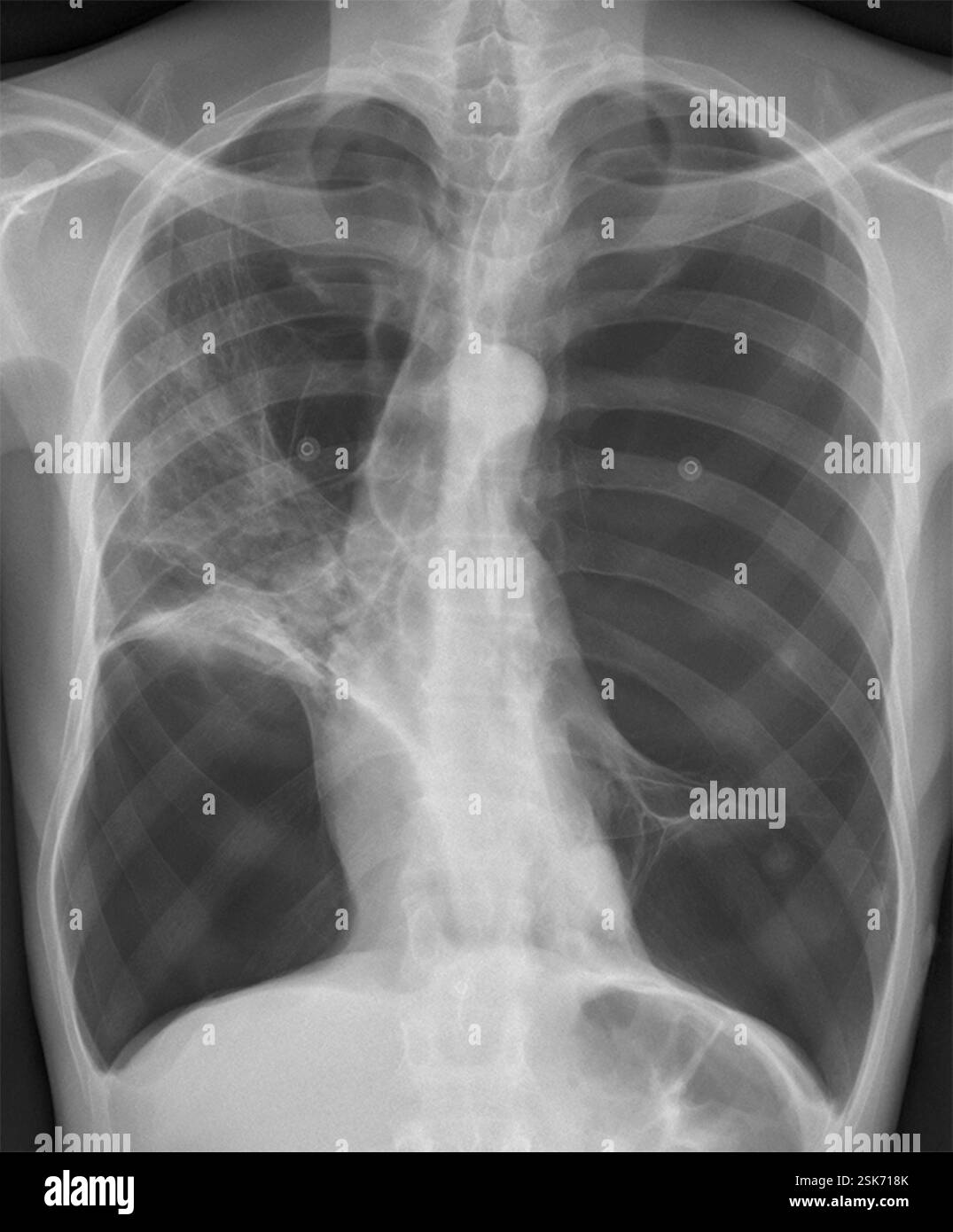 Emphysema lung disease. Frontal chest X-ray of the lungs of a 58-year ...
