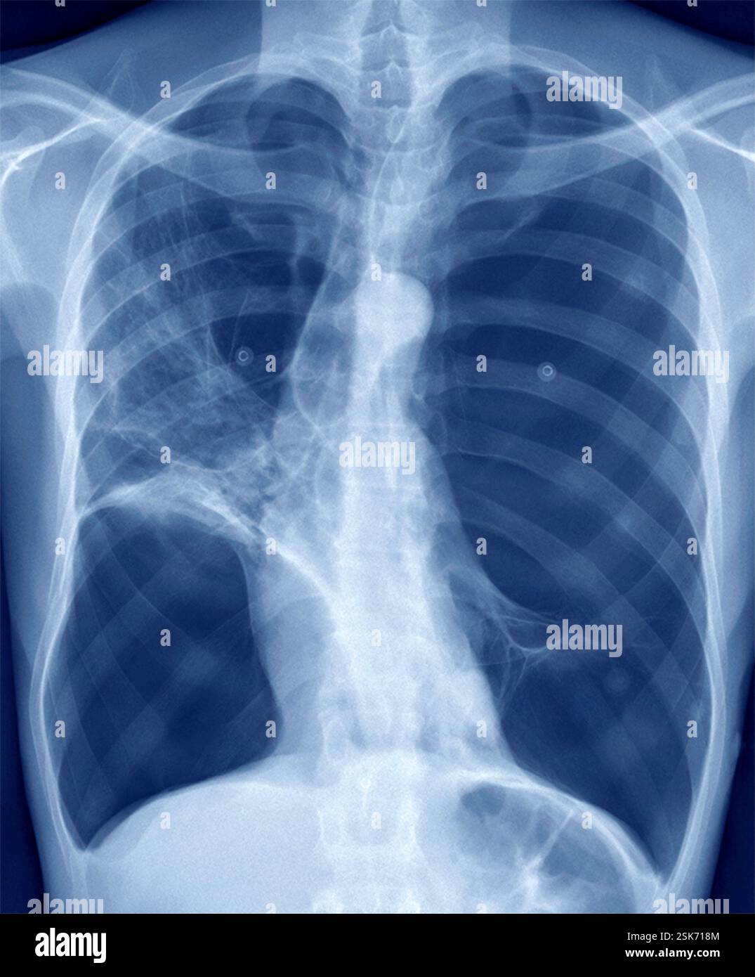Emphysema lung disease. Frontal chest X-ray of the lungs of a 58-year ...