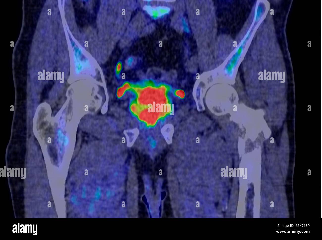 Prostate cancer. Coloured coronal combined computed tomography (CT) and positron emission ...