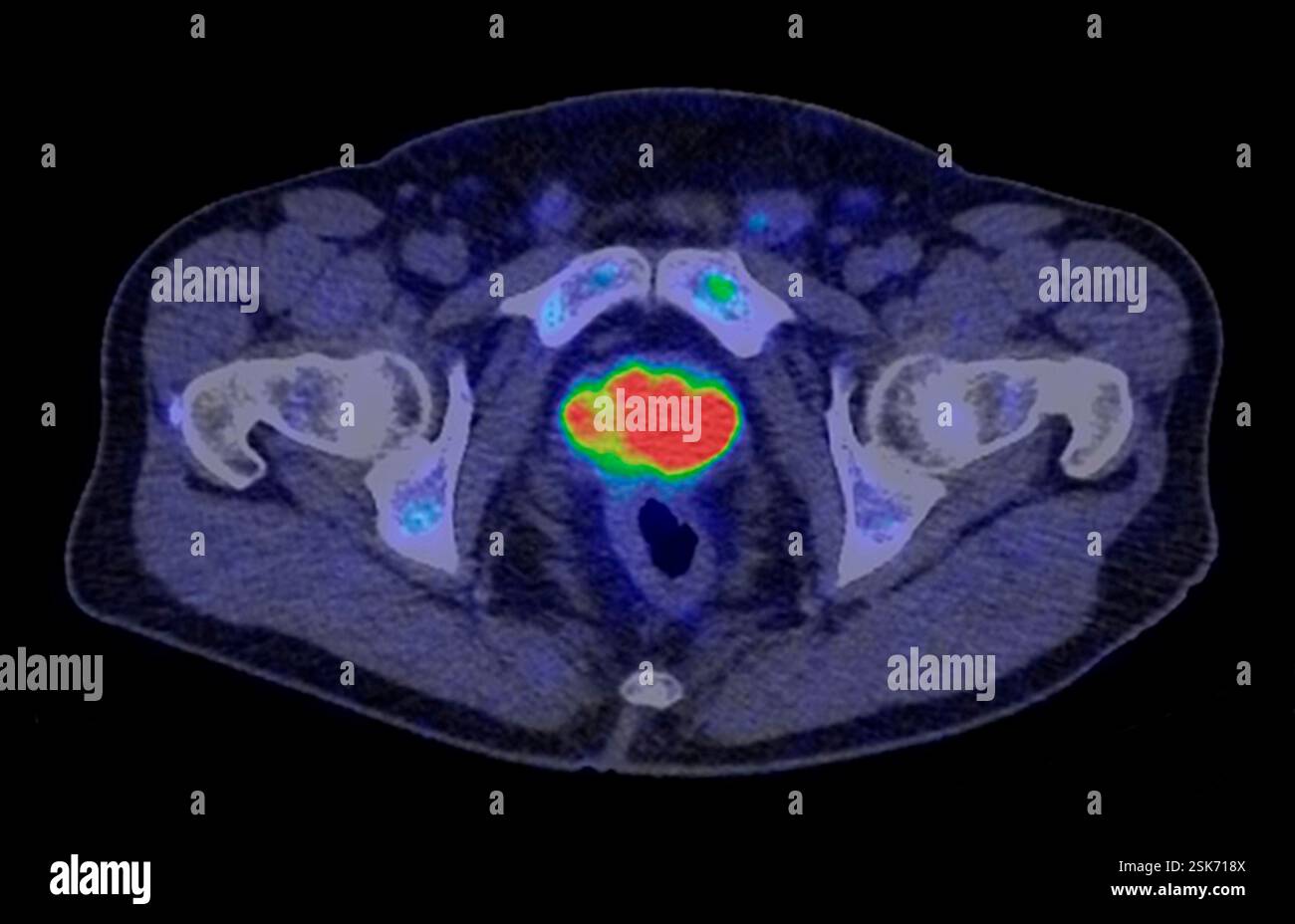 Prostate cancer. Coloured axial combined computed tomography (CT) and positron emission ...