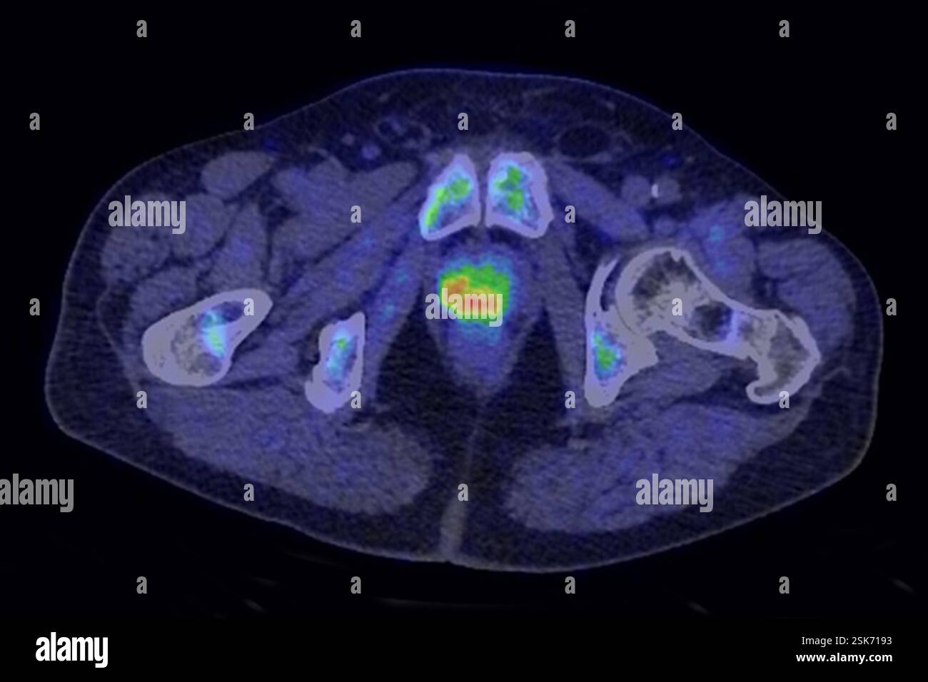 Prostate cancer. Coloured axial combined computed tomography (CT) and positron emission ...