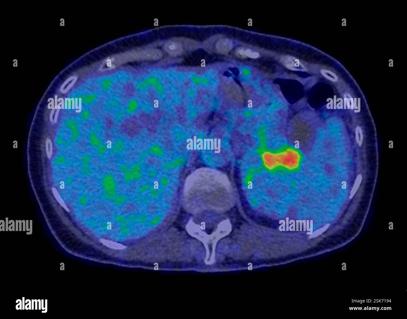 Pancreatic cancer. Coloured axial combined computed tomography (CT) and positron emission ...