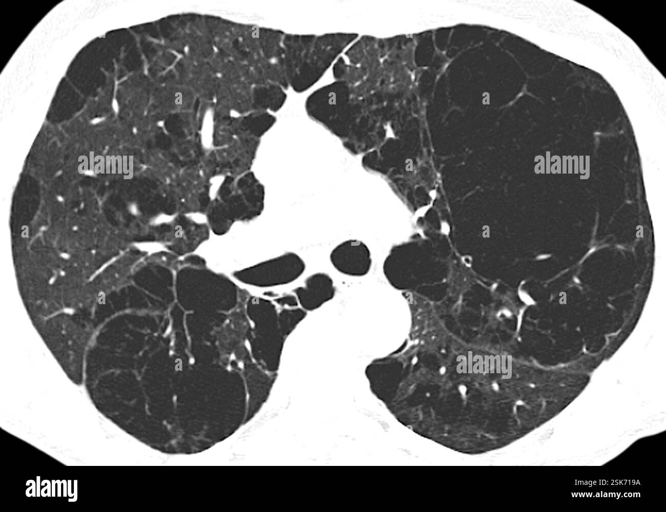 Emphysema lung disease. Axial computed tomography (CT) scan through the ...