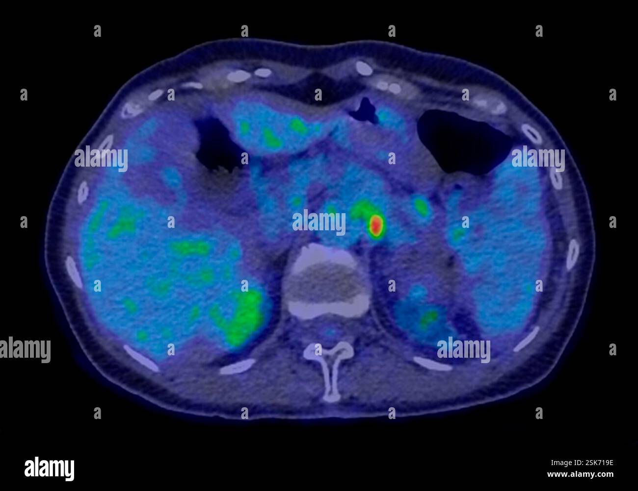 Pancreatic cancer. Coloured axial combined computed tomography (CT) and ...