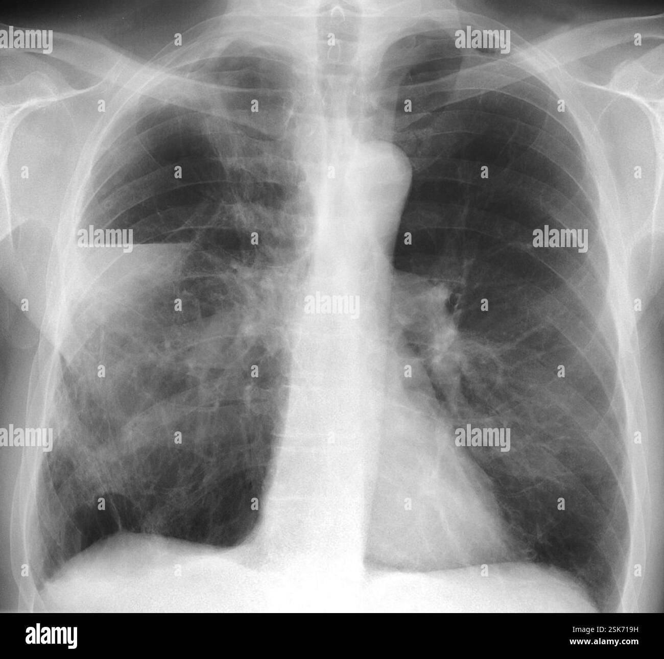 Emphysema lung disease. Frontal chest X-ray of the lungs of a 67-year ...