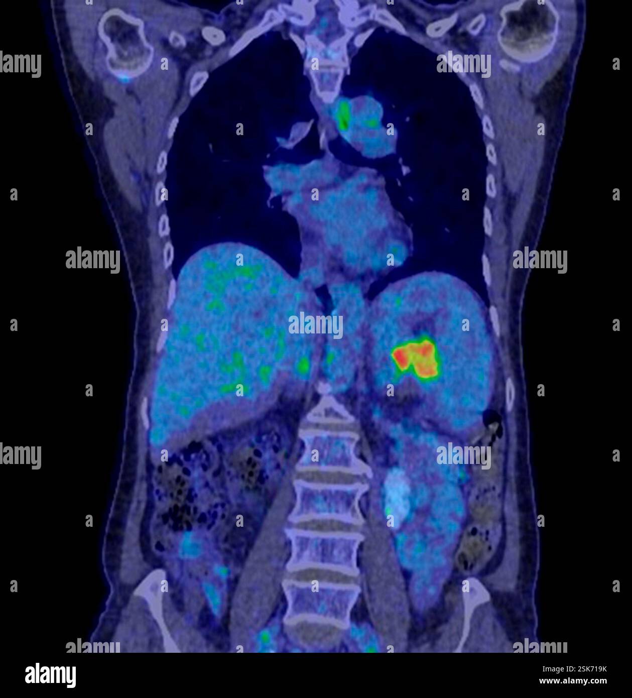 Pancreatic cancer. Coloured coronal combined computed tomography (CT) and positron emission ...