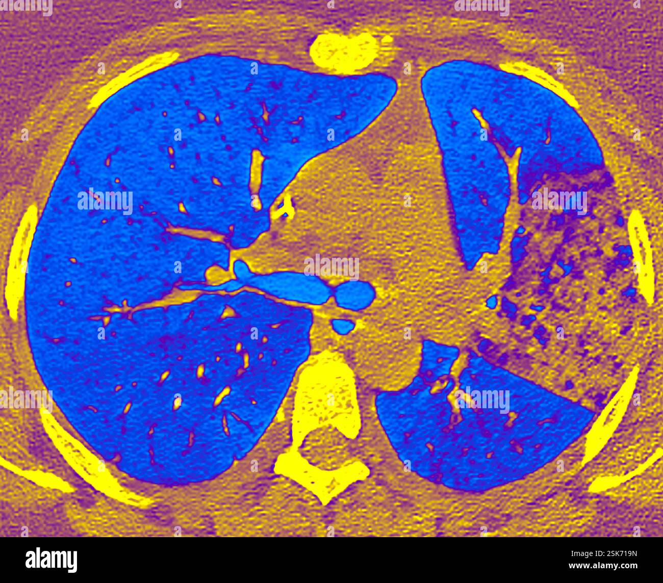 Bacterial pneumonia. Coloured Axial computed tomography (CT) scan ...