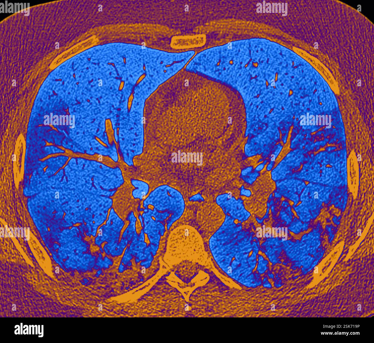 Lungs affected by Covid-19 pneumonia. Coloured axial computed ...