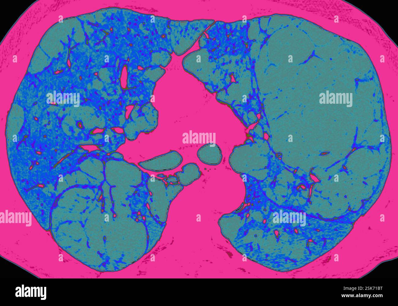 Emphysema lung disease. Coloured axial computed tomography (CT) scan ...