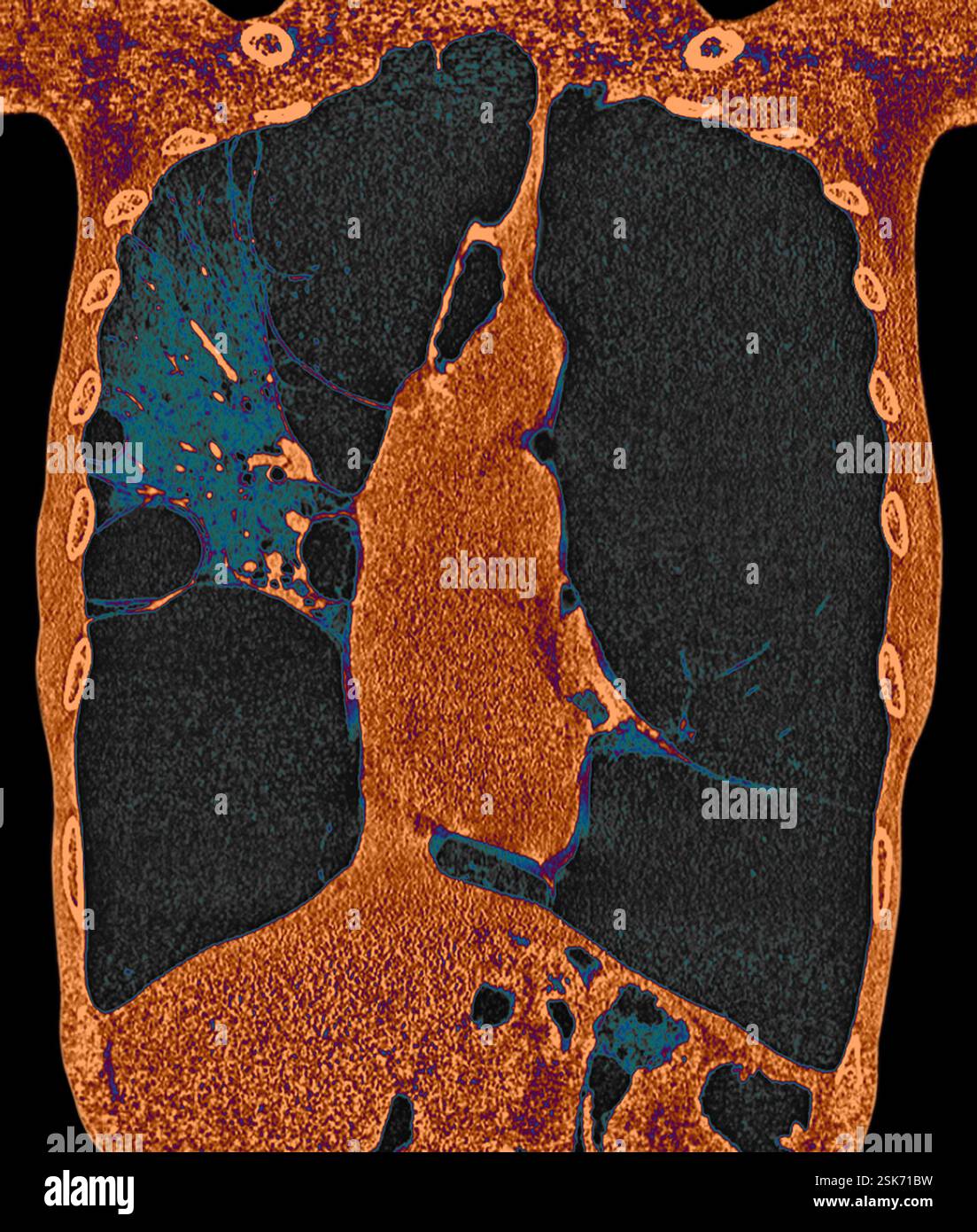 Emphysema lung disease. Coloured coronal chest computed tomography (CT ...