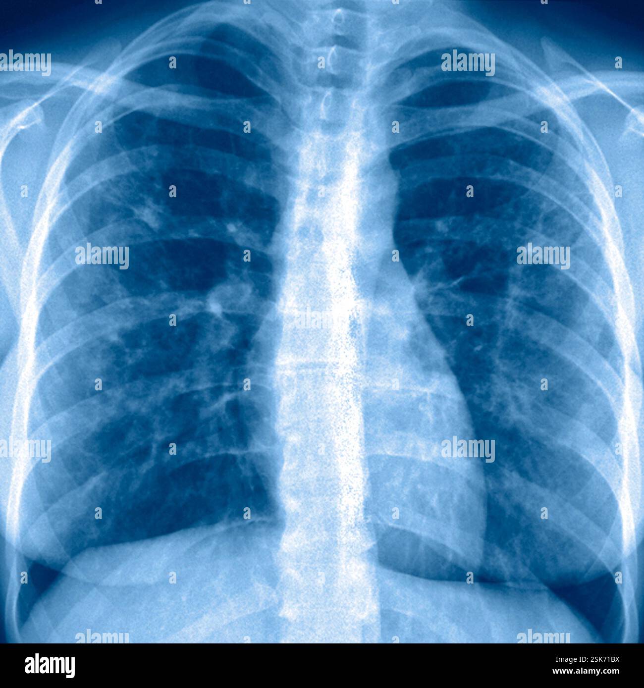 Small cell lung cancer, CT scan Stock Photo - Alamy