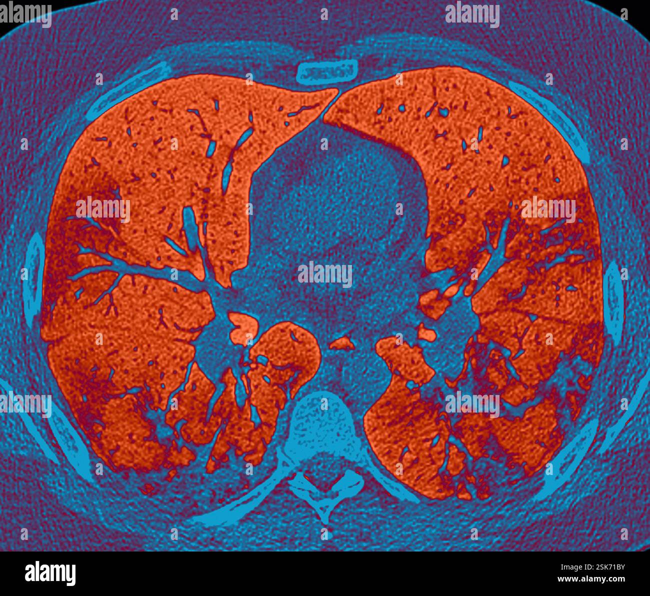 Lungs affected by Covid-19 pneumonia. Coloured axial computed ...