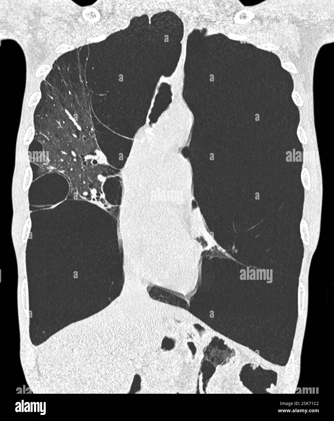 Emphysema lung disease. Coronal chest computed tomography (CT) scan ...