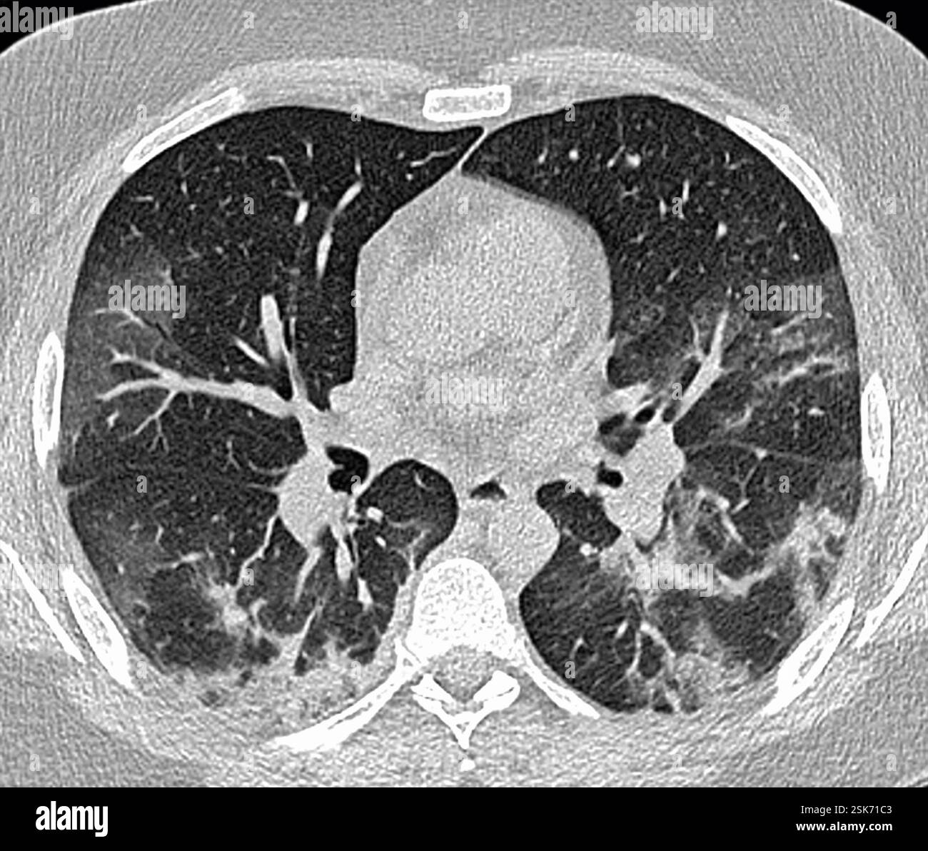 Lungs affected by Covid-19 pneumonia. Axial computed tomography (CT ...