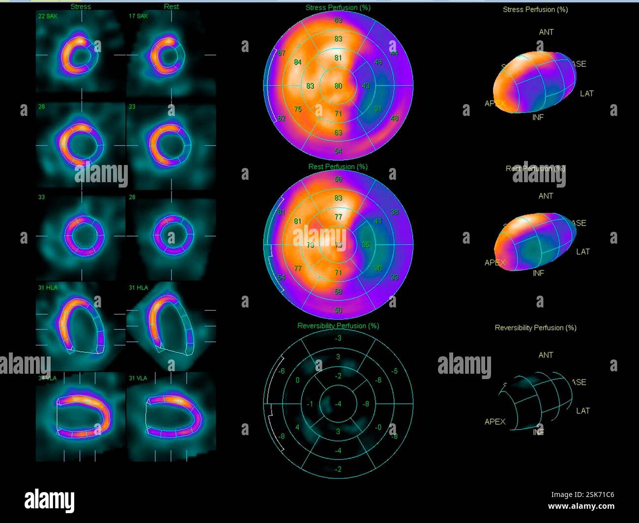 Small cell lung cancer, CT scan Stock Photo - Alamy