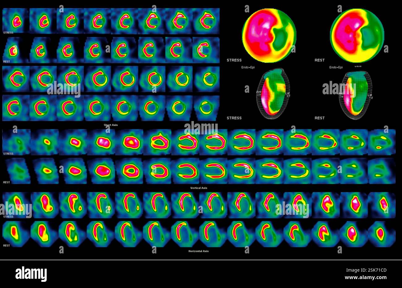 Small cell lung cancer, CT scan Stock Photo - Alamy
