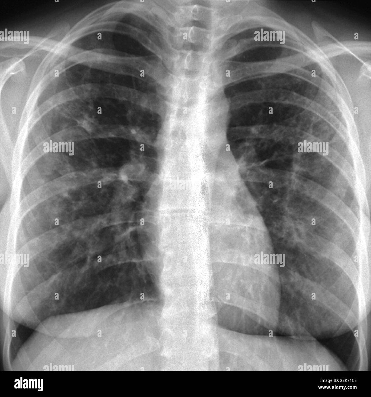 Pulmonary embolism, ventilation-perfusion scintigram Stock Photo - Alamy