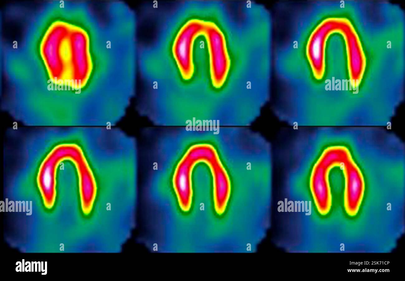 Healthy heart. Coloured single photon emission computed tomography ...