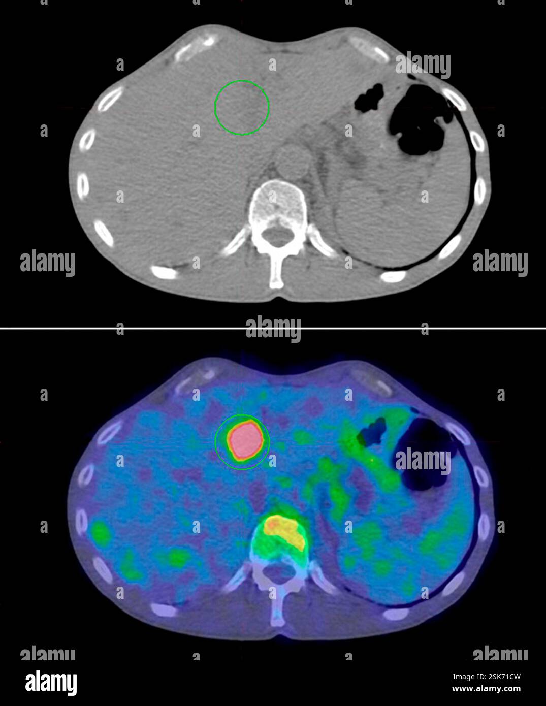 Secondary cancer in the liver. Comparison of axial computed tomography ...