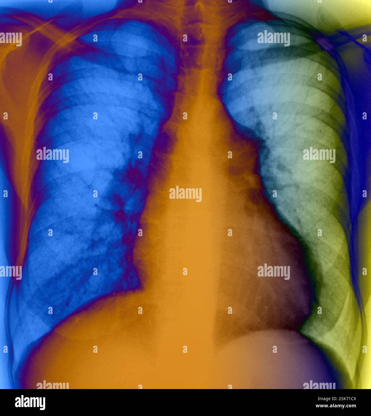 Cardiac hypertrophy. Coloured frontal chest X-ray of the heart (centre ...
