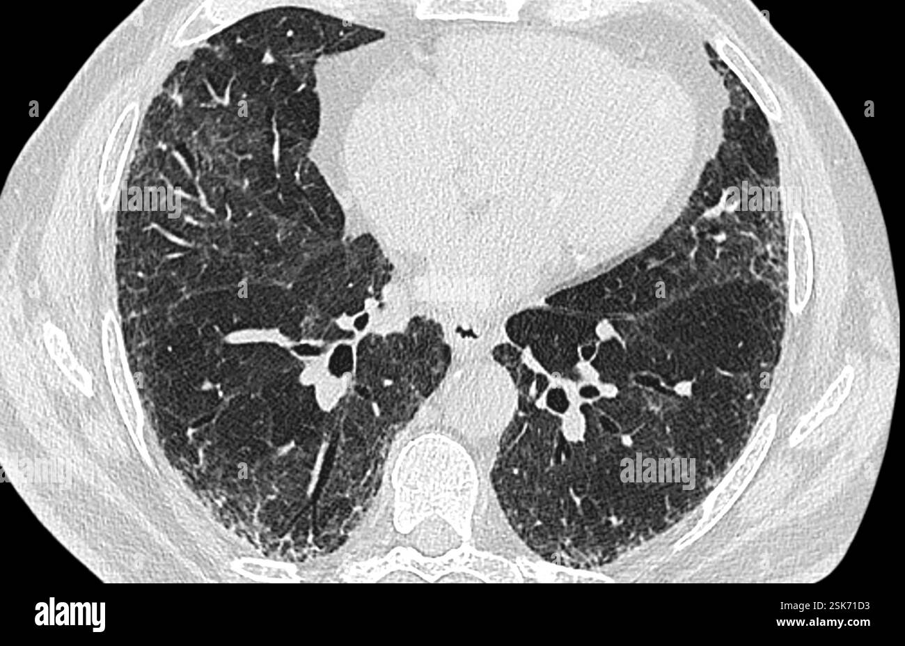 Computed tomography (CT) scan (axial view) of the lungs of a 64 year ...