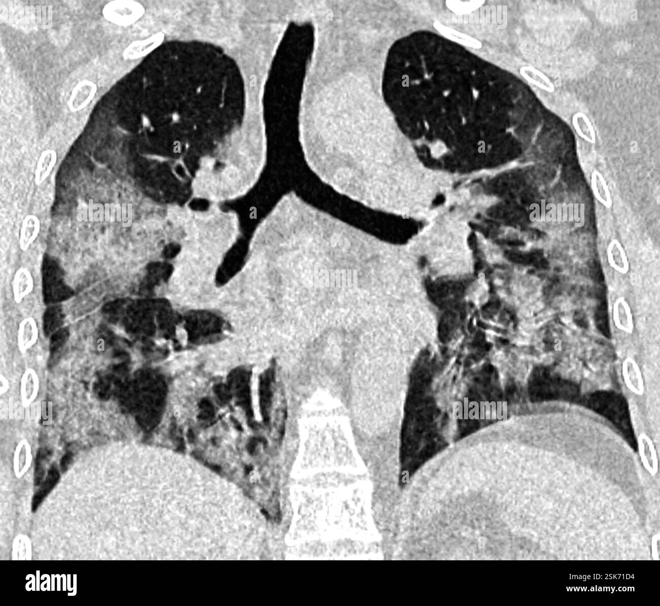 Computed tomography (CT) scan (frontal view) of the lungs of a 47 year ...