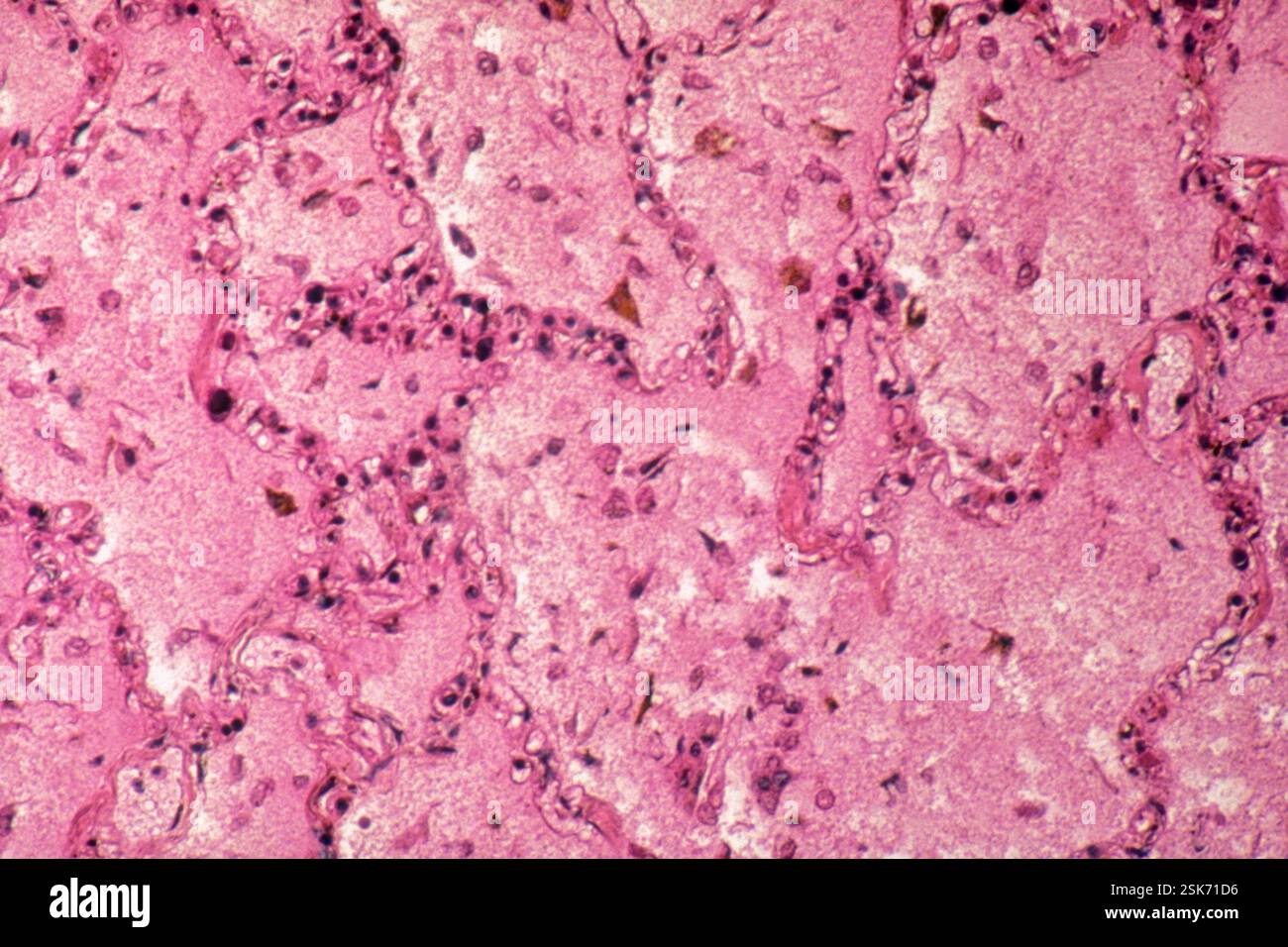 Acute pulmonary oedema. Light micrograph of a section through lung ...