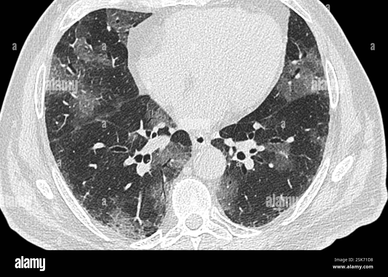 Computed tomography (CT) scan (axial view) of the lungs of a 64 year ...