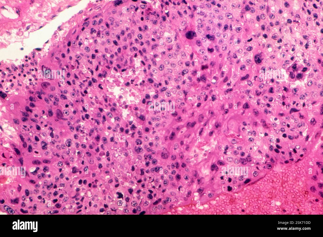 Choriocarcinoma testicle cancer. Light micrograph of a section through ...
