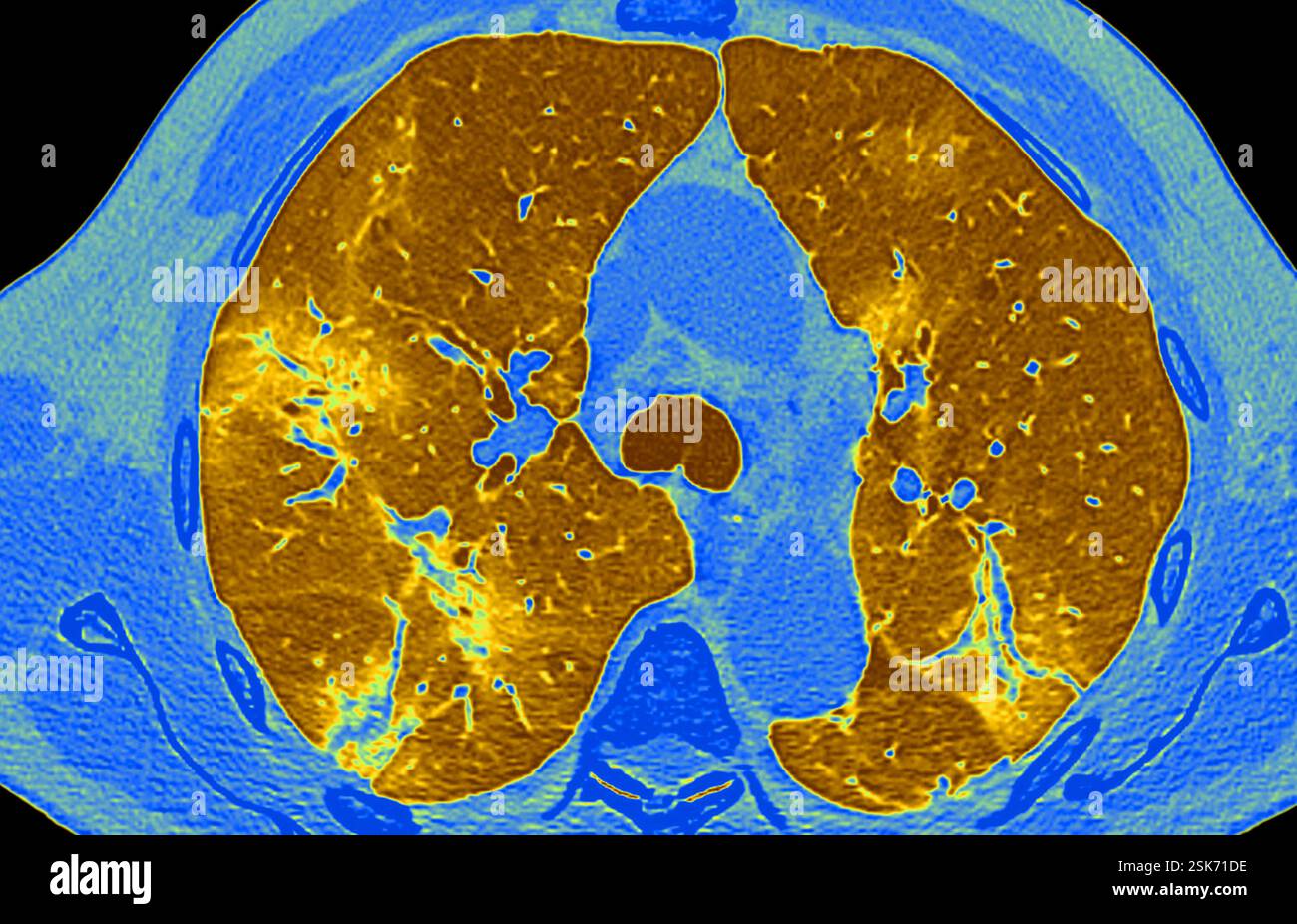 Coloured computed tomography (CT) scan (axial view) of the lungs of a ...