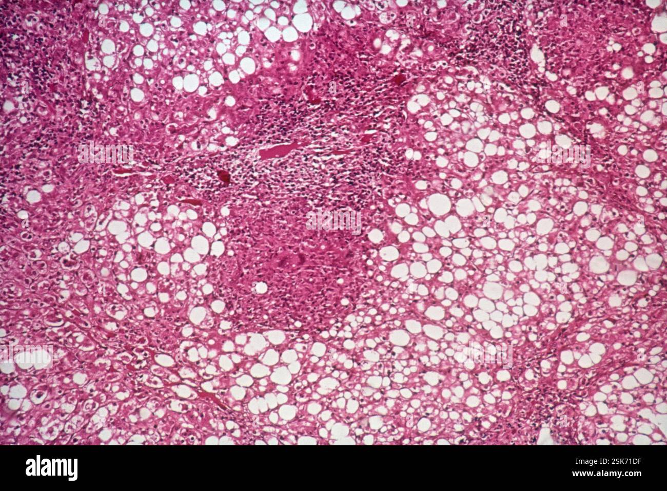 Fatty liver disease. Light micrograph through liver tissue in a case of ...