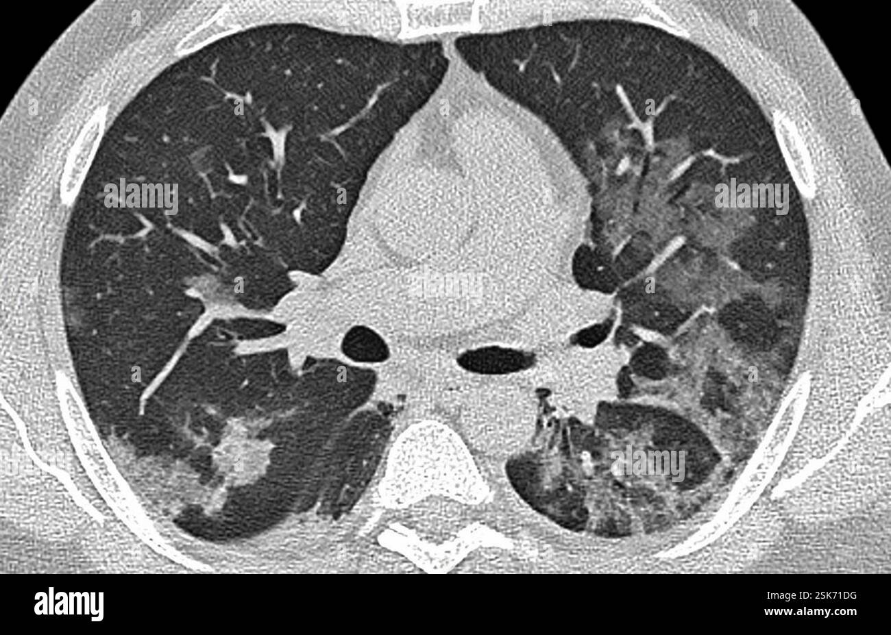 Computed tomography (CT) scan (axial view) of the lungs of a 50 year ...