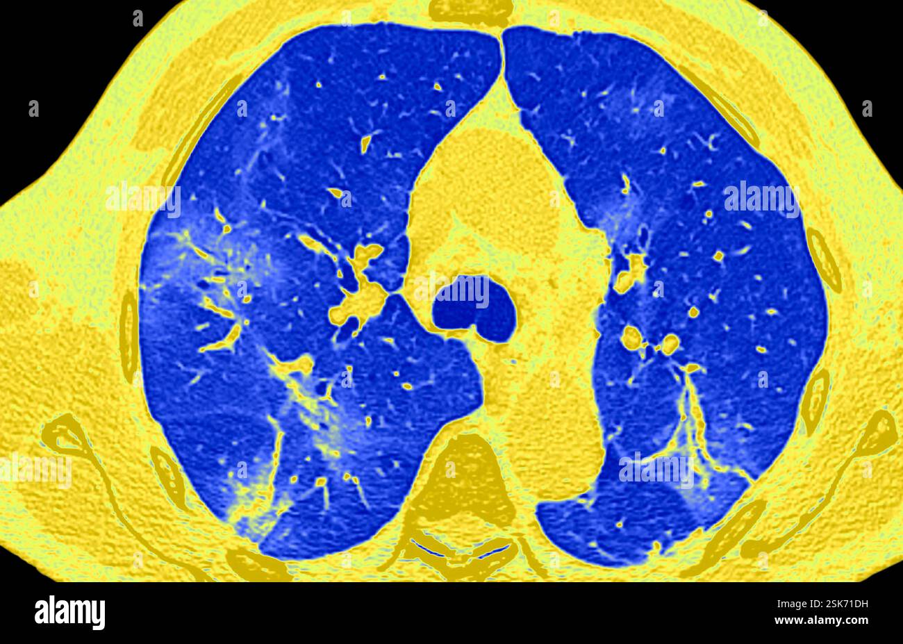 Coloured computed tomography (CT) scan (axial view) of the lungs of a ...