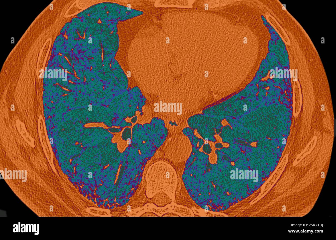 Computed tomography (CT) scan (axial view) of the lungs of a 64 year ...