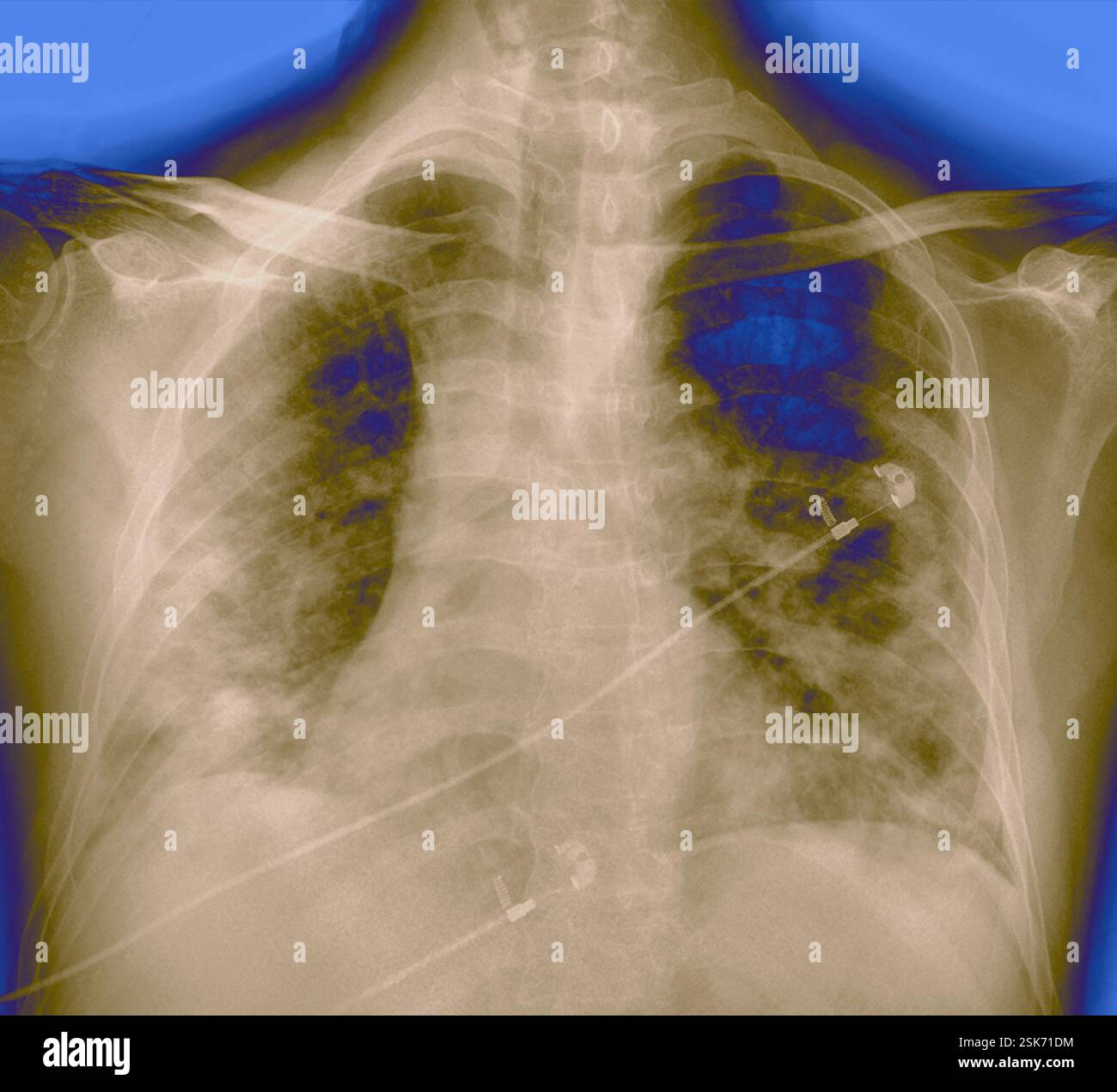 Coloured X-ray (frontal view) of the lungs of a 47 year old male ...