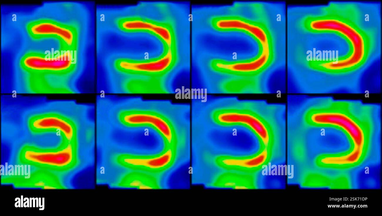 Coloured sagittal SPECT (single photon emission computed tomography ...