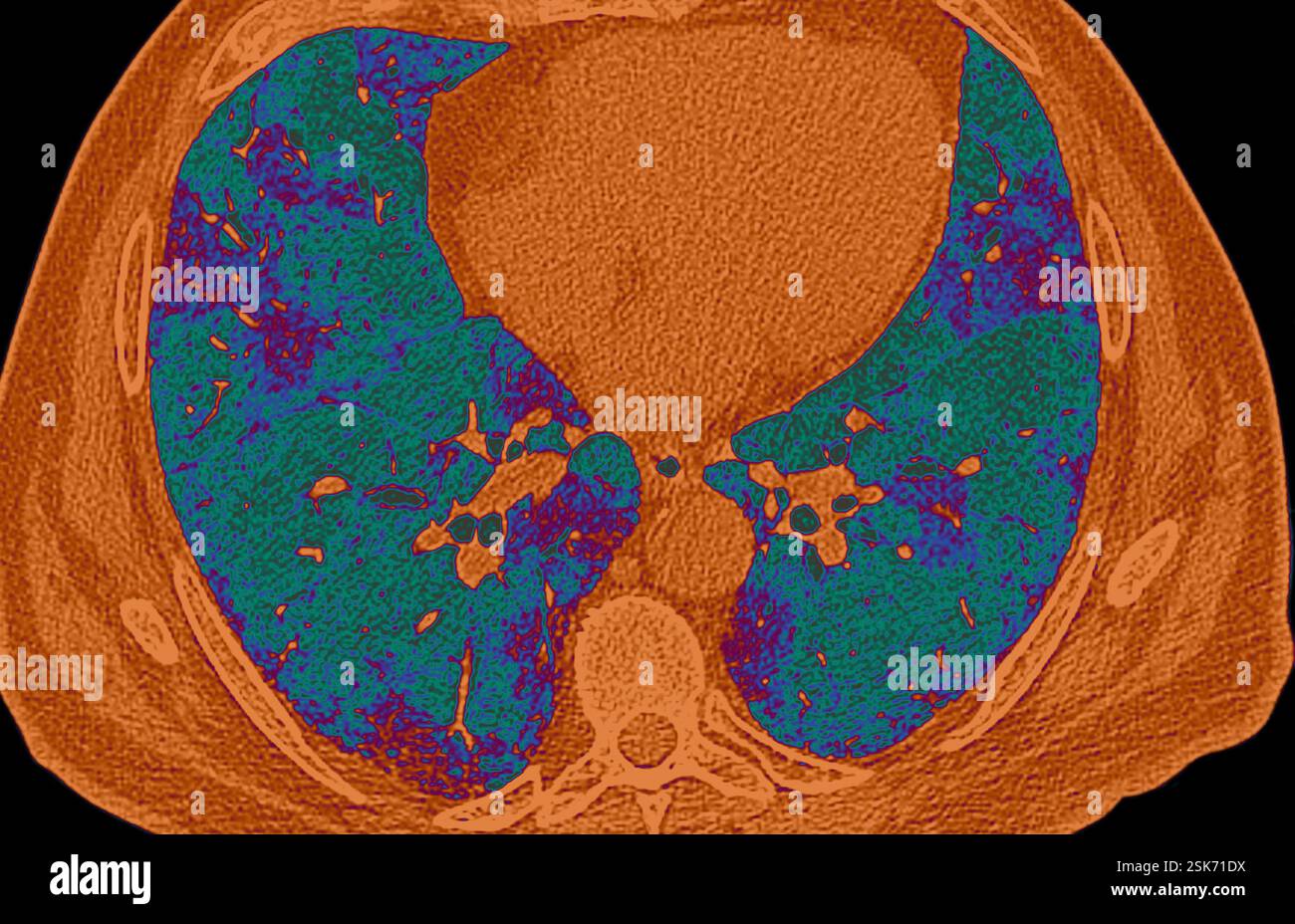 Coloured computed tomography (CT) scan (axial view) of the lungs of a ...